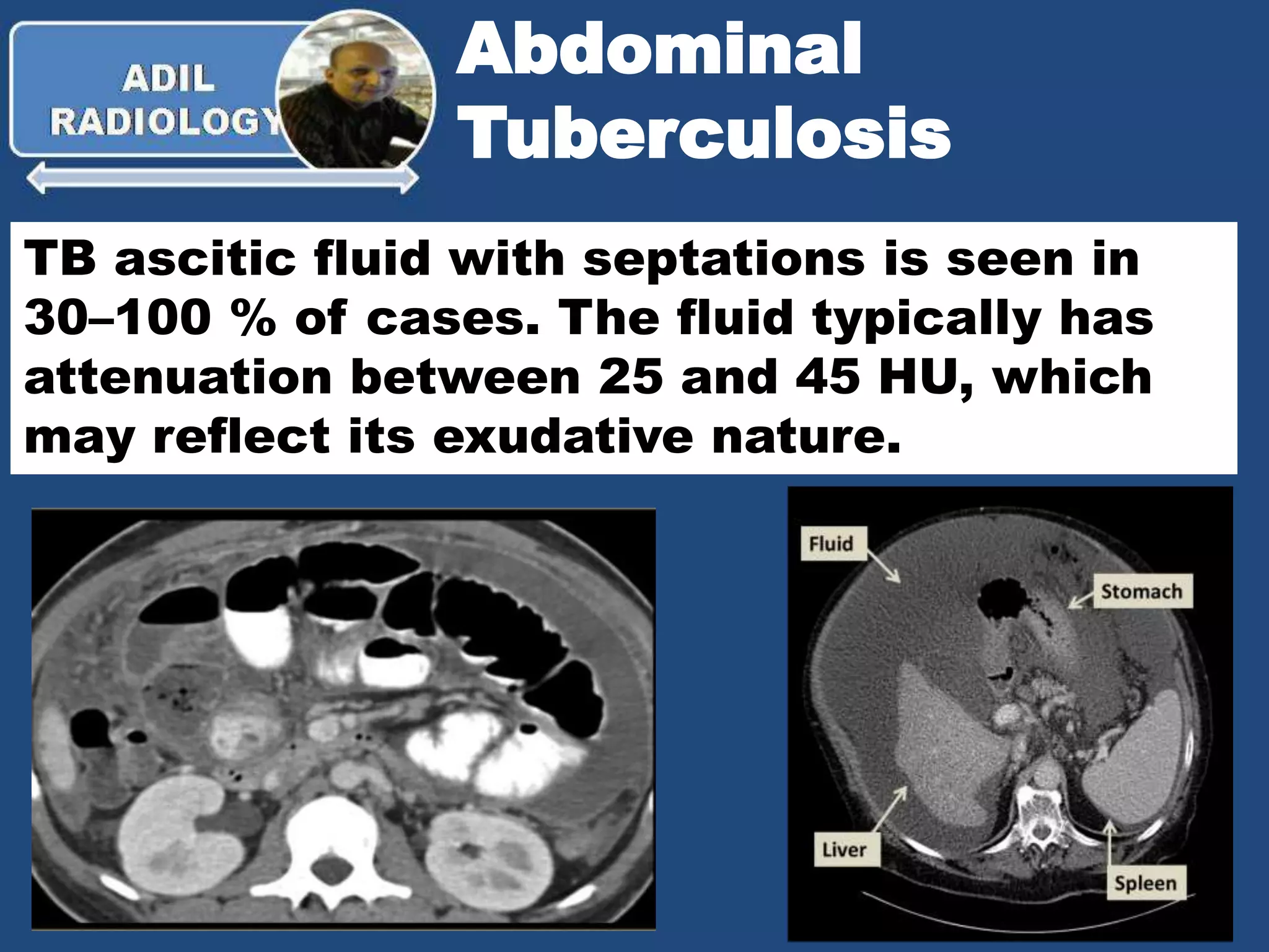 Abdominal tb | PPTX