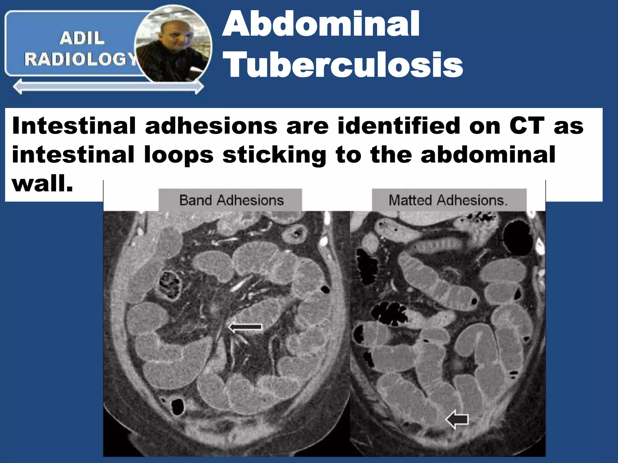 Abdominal tb | PPTX