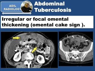 Abdominal tb | PPTX