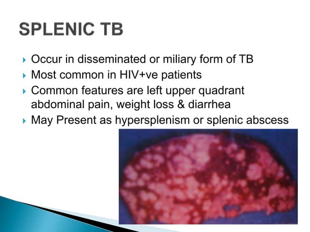 GASTROINTESTINAL TUBERCULOSIS ABDOMINAL TUBERCULOSIS | PPT