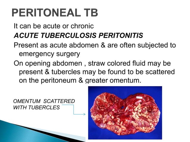 GASTROINTESTINAL TUBERCULOSIS ABDOMINAL TUBERCULOSIS | PPT