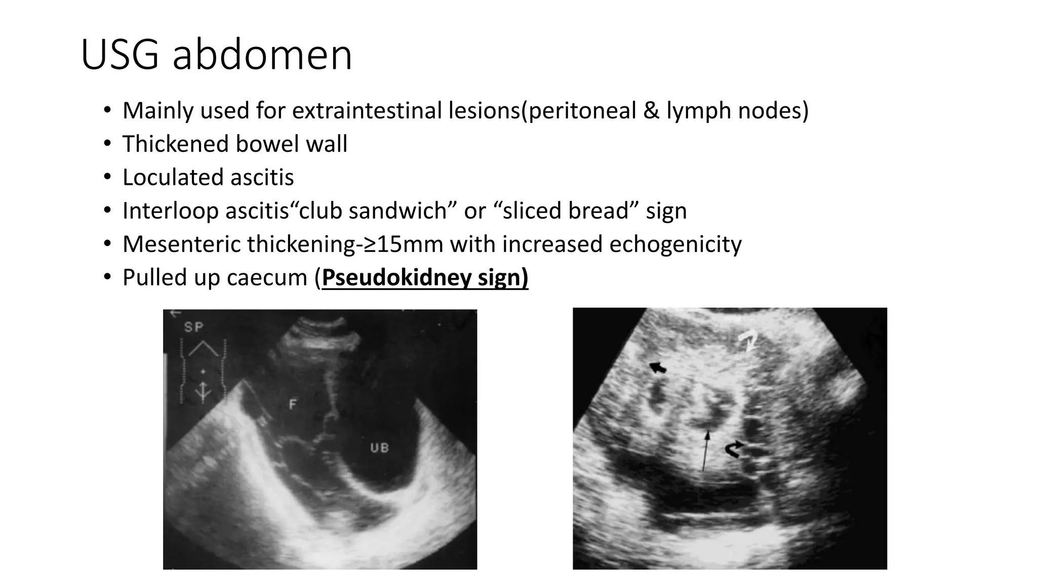 Abdominal Tuberculosis-Management | PPTX