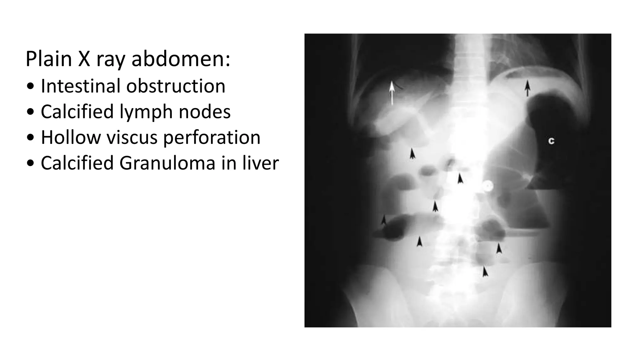 Abdominal Tuberculosis-Management | PPTX