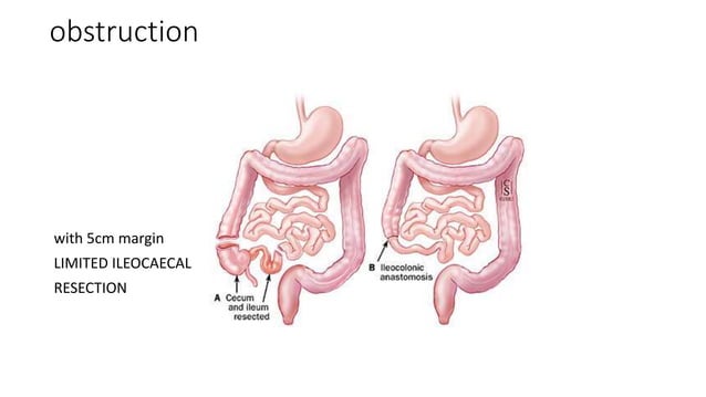 Abdominal Tuberculosis-Management | PPTX