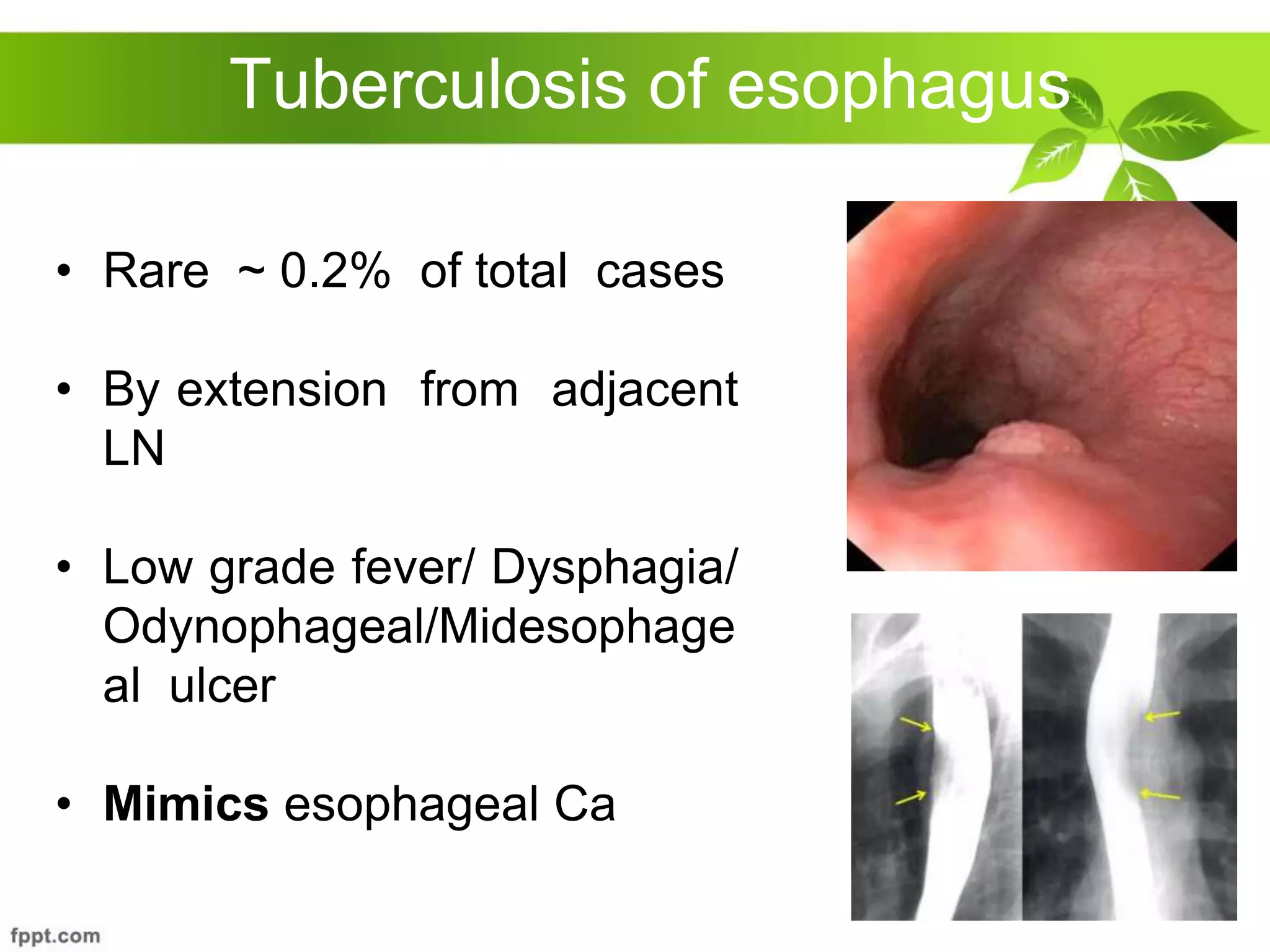 Abdominal Tuberculosis | PPTX