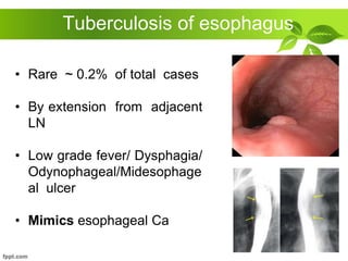Abdominal Tuberculosis | PPTX