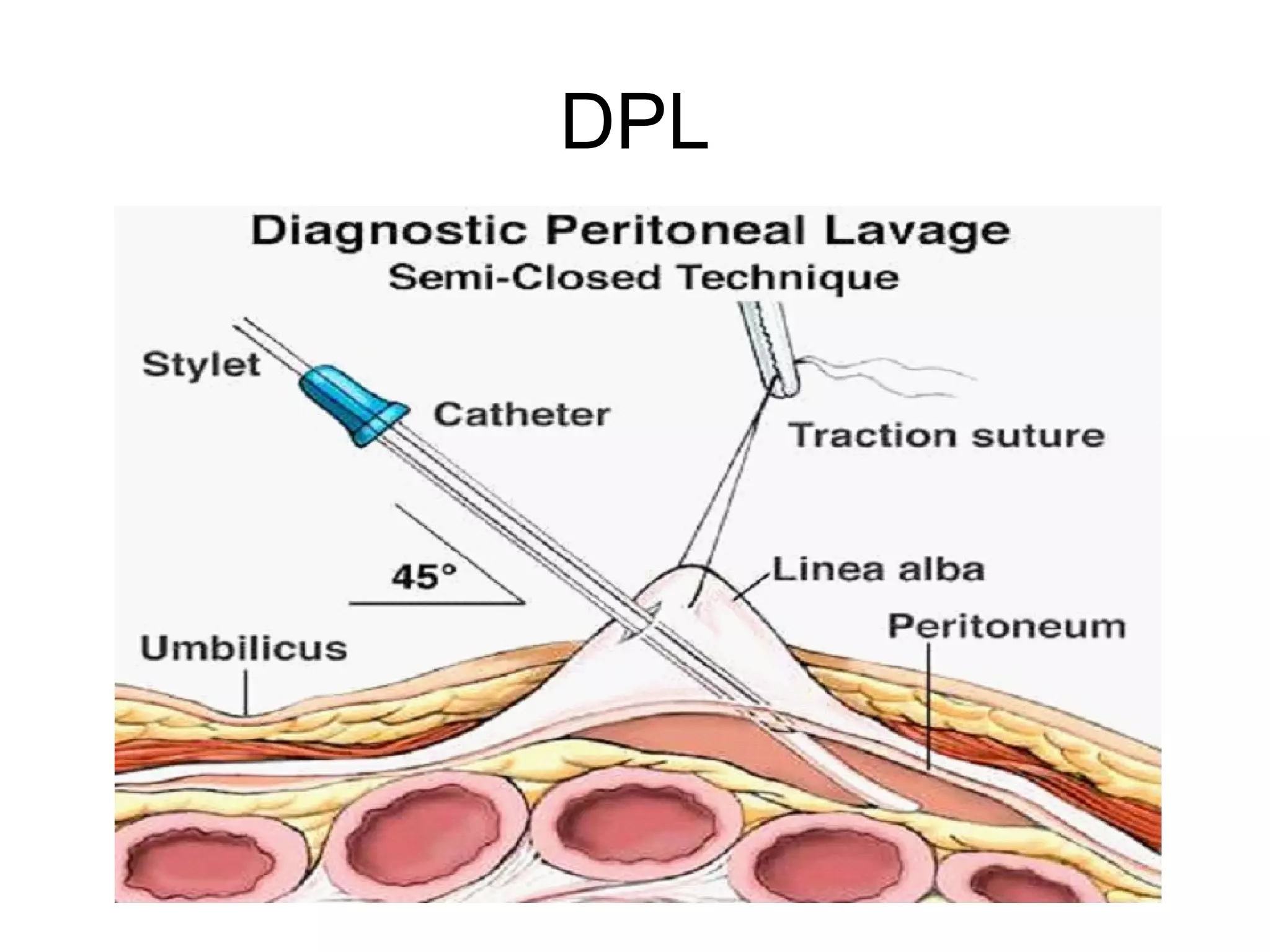 Abdominal trauma | PPT