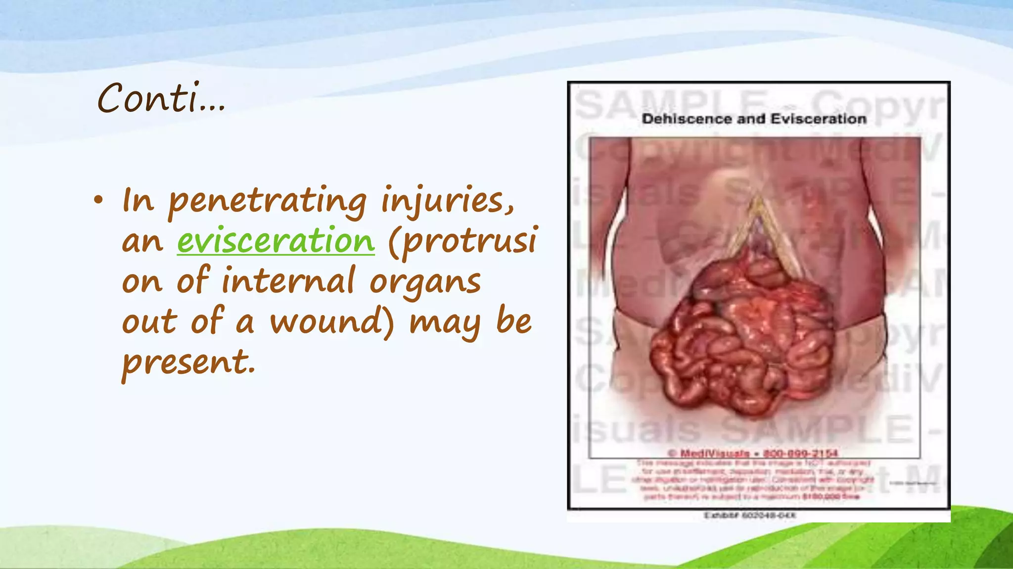 Abdominal trauma | PPTX