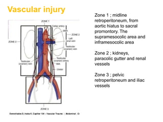 Abdominal Trauma Zones