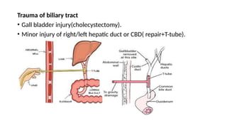 abdominal trauma powerpoint explained for medical students | PPT
