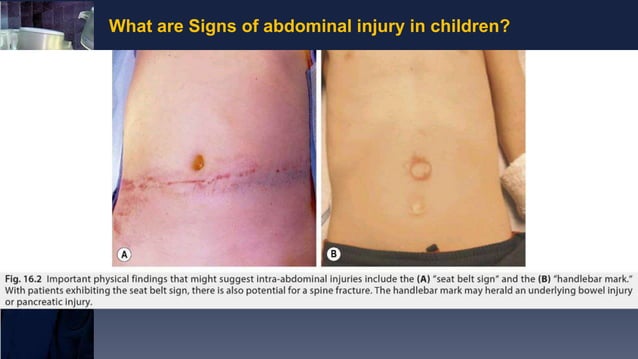 ABDOMINAL TRAUMA in pediatrics part one. | PPTX | First Aid | Injuries