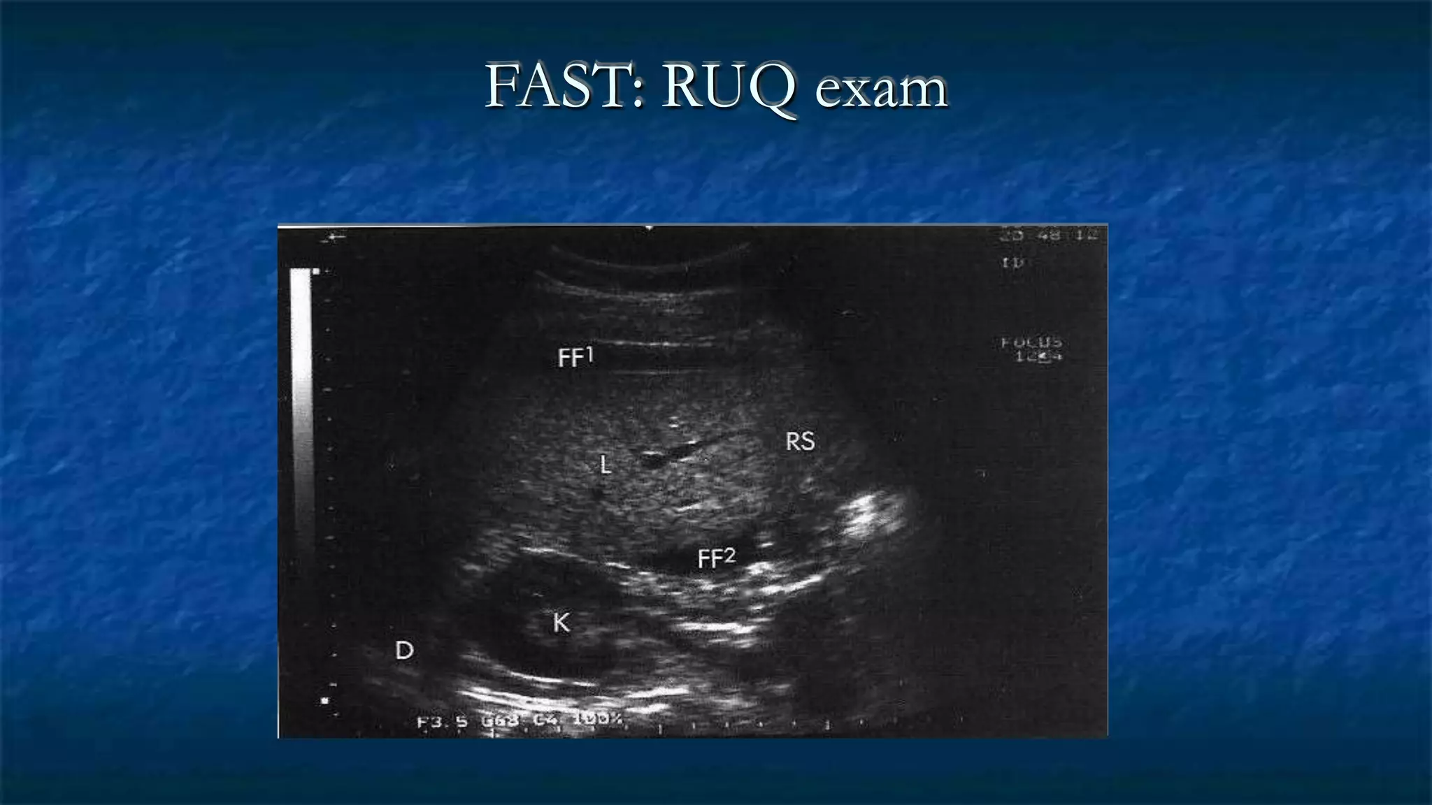 Abdominal Trauma and FAST scan (Dr. Derhim Afaqeeh , Yemen ) | PPTX