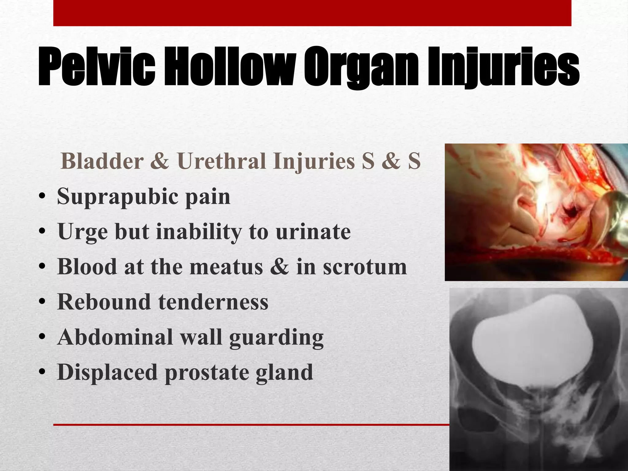 Abdominal Trauma for Nursing | PPTX