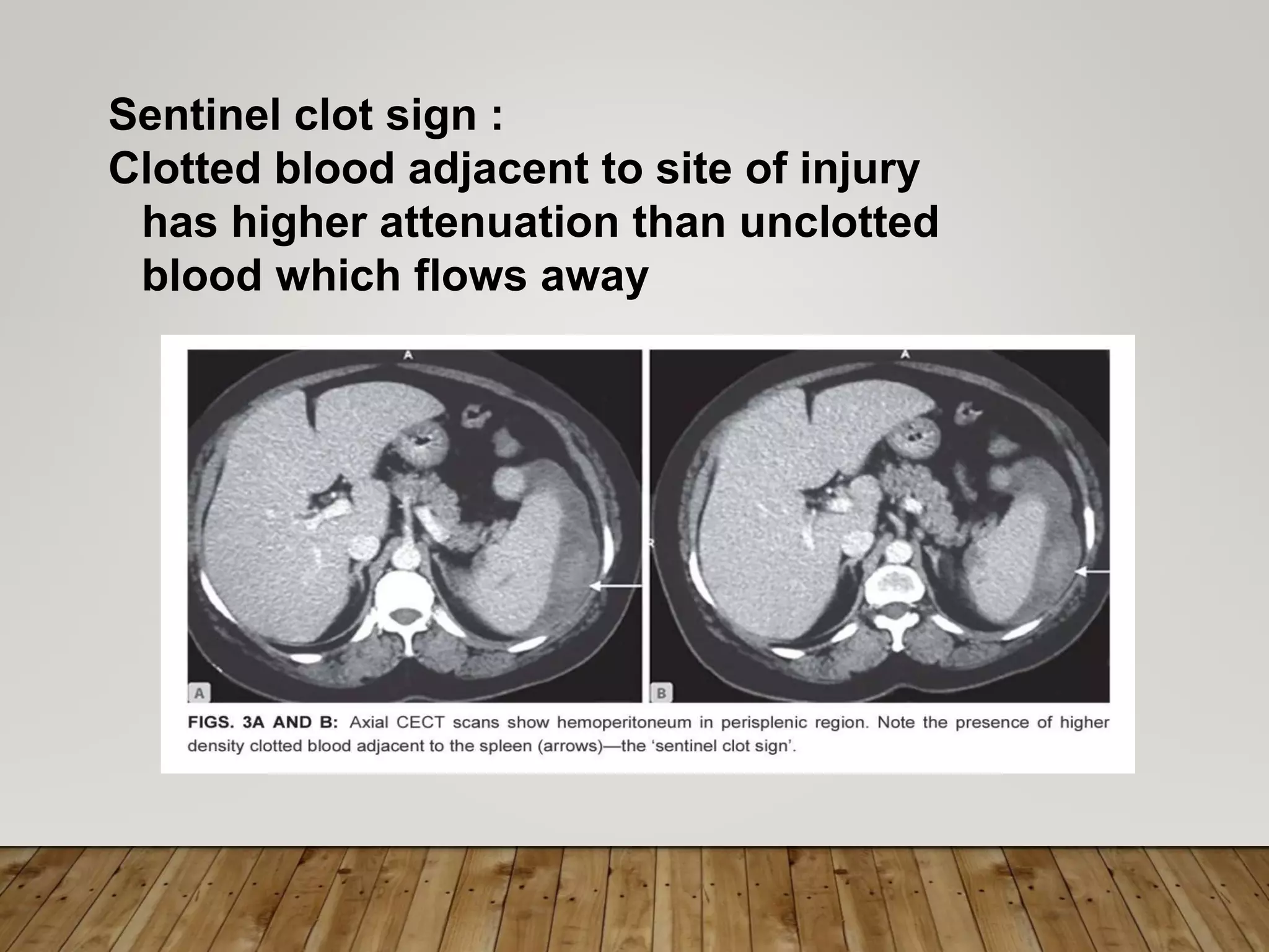ABDOMINAL TRAUMA PPT.pptx