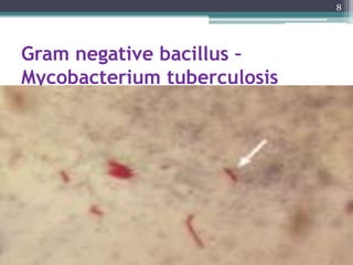Abdominal tuberculosis | PPTX
