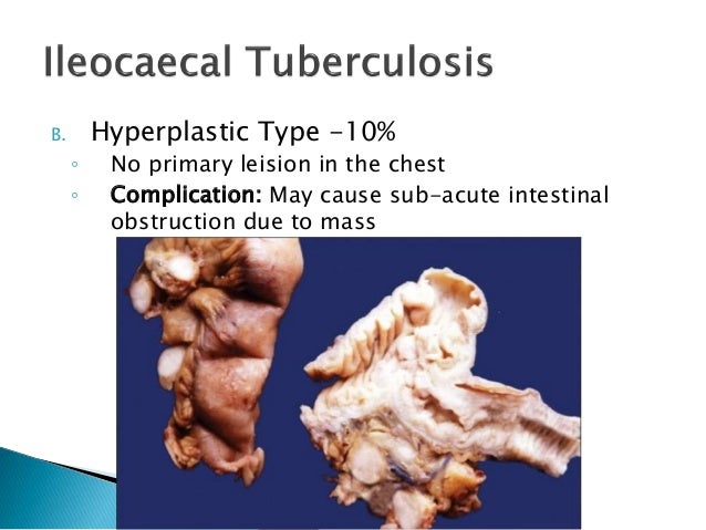 Abdominal tuberculosis