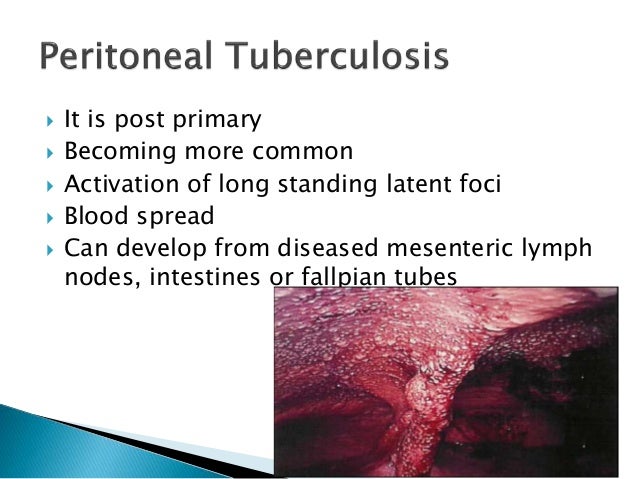 Abdominal tuberculosis