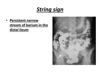 Abdominal tuberculosis | PPTX