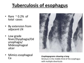 Abdominal tuberculosis | PPTX
