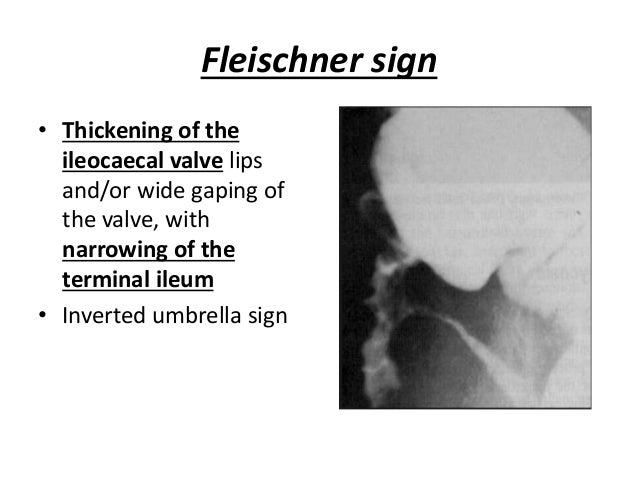 Abdominal tuberculosis