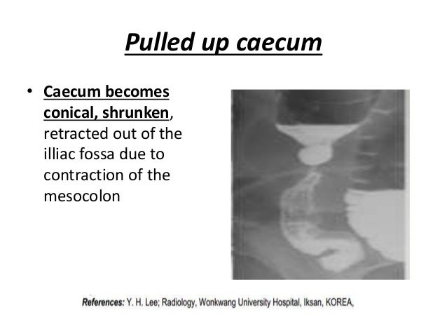 Abdominal tuberculosis