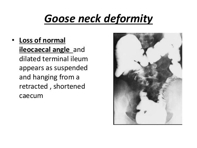 Abdominal tuberculosis