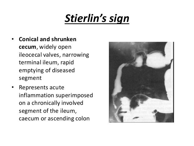 Abdominal tuberculosis