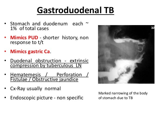 Abdominal tuberculosis