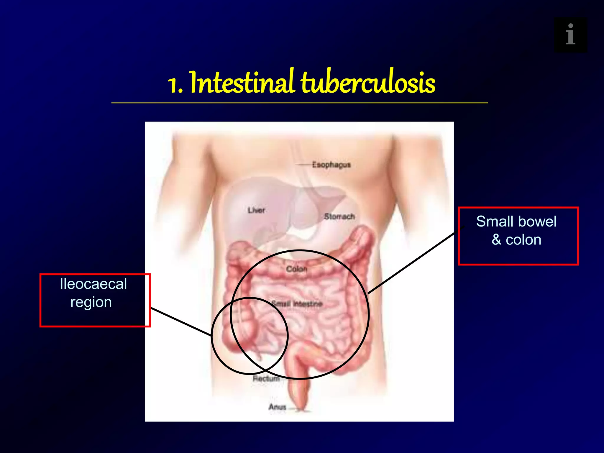 Abdominal tuberculosis dr syed obaid | PPTX