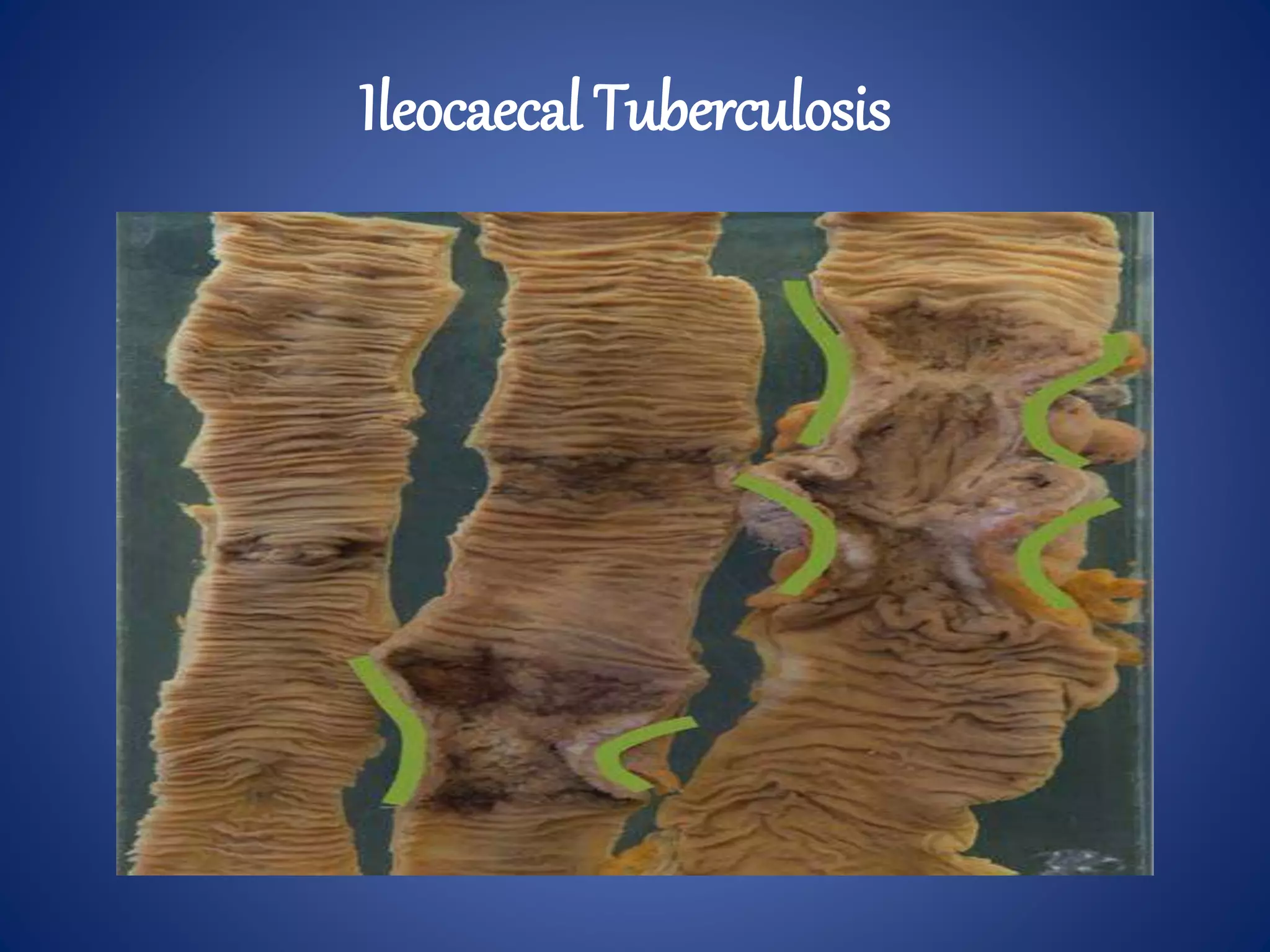 Abdominal tuberculosis dr syed obaid | PPT