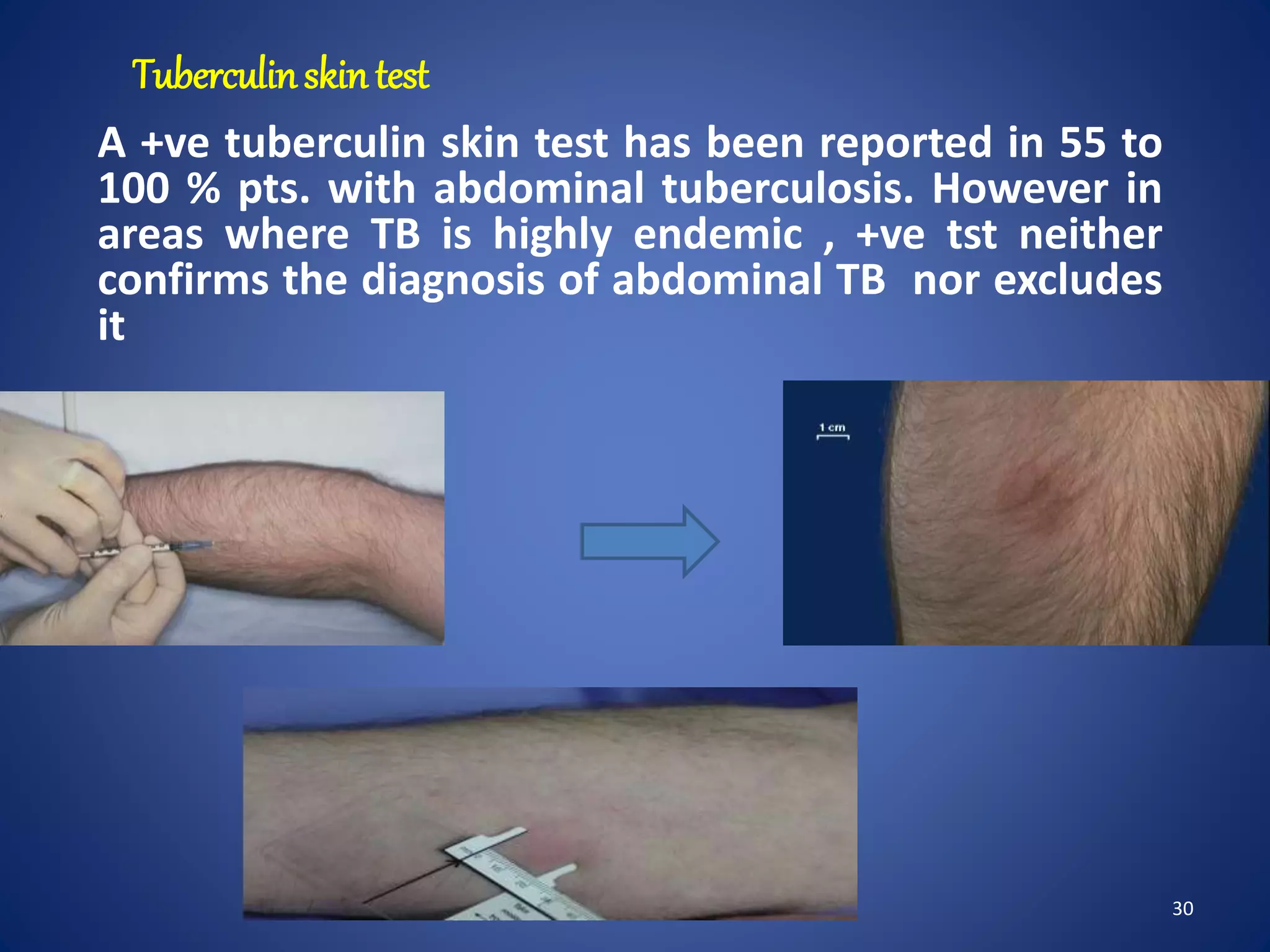 Abdominal tuberculosis dr syed obaid | PPTX