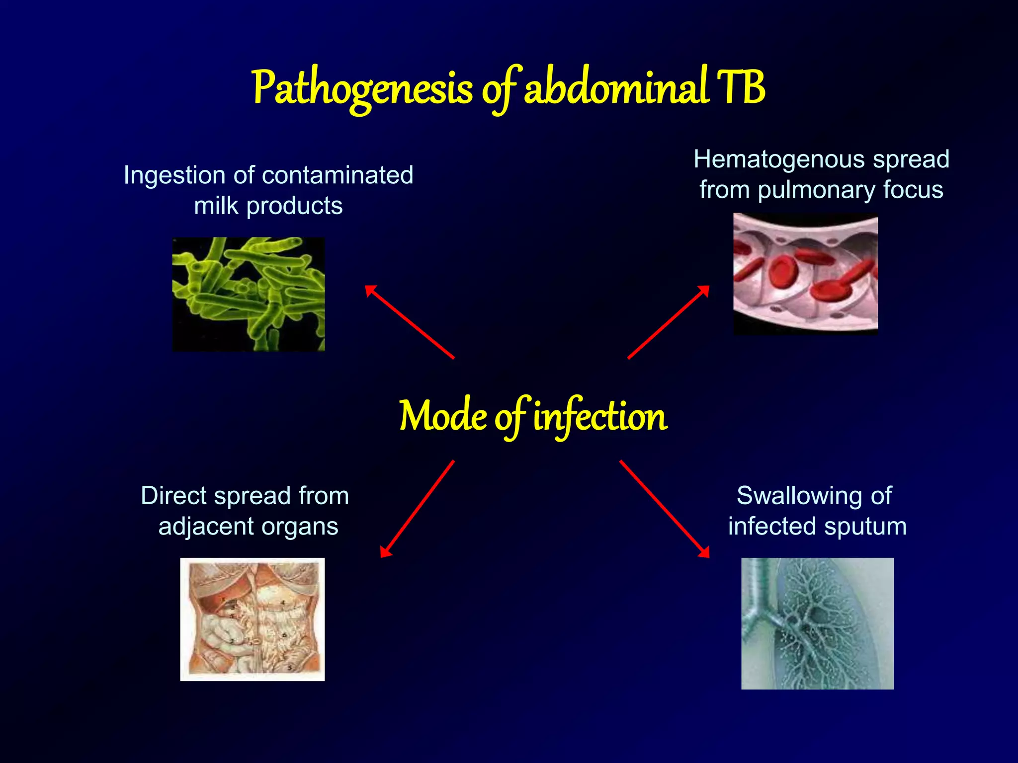 Abdominal tuberculosis dr syed obaid | PPT