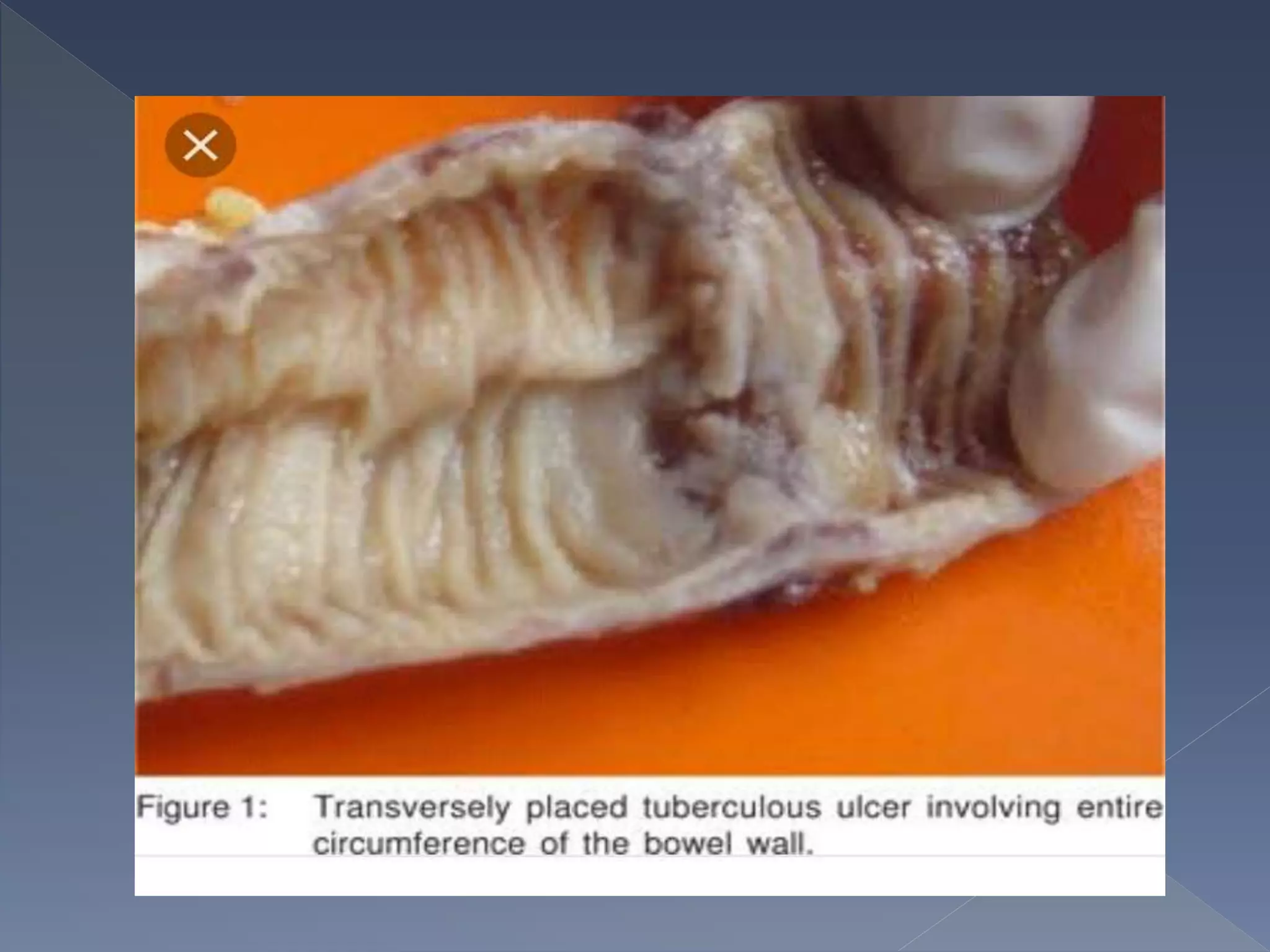 Abdominal tuberculosis | PPTX | Digestive Disorders | Diseases and ...