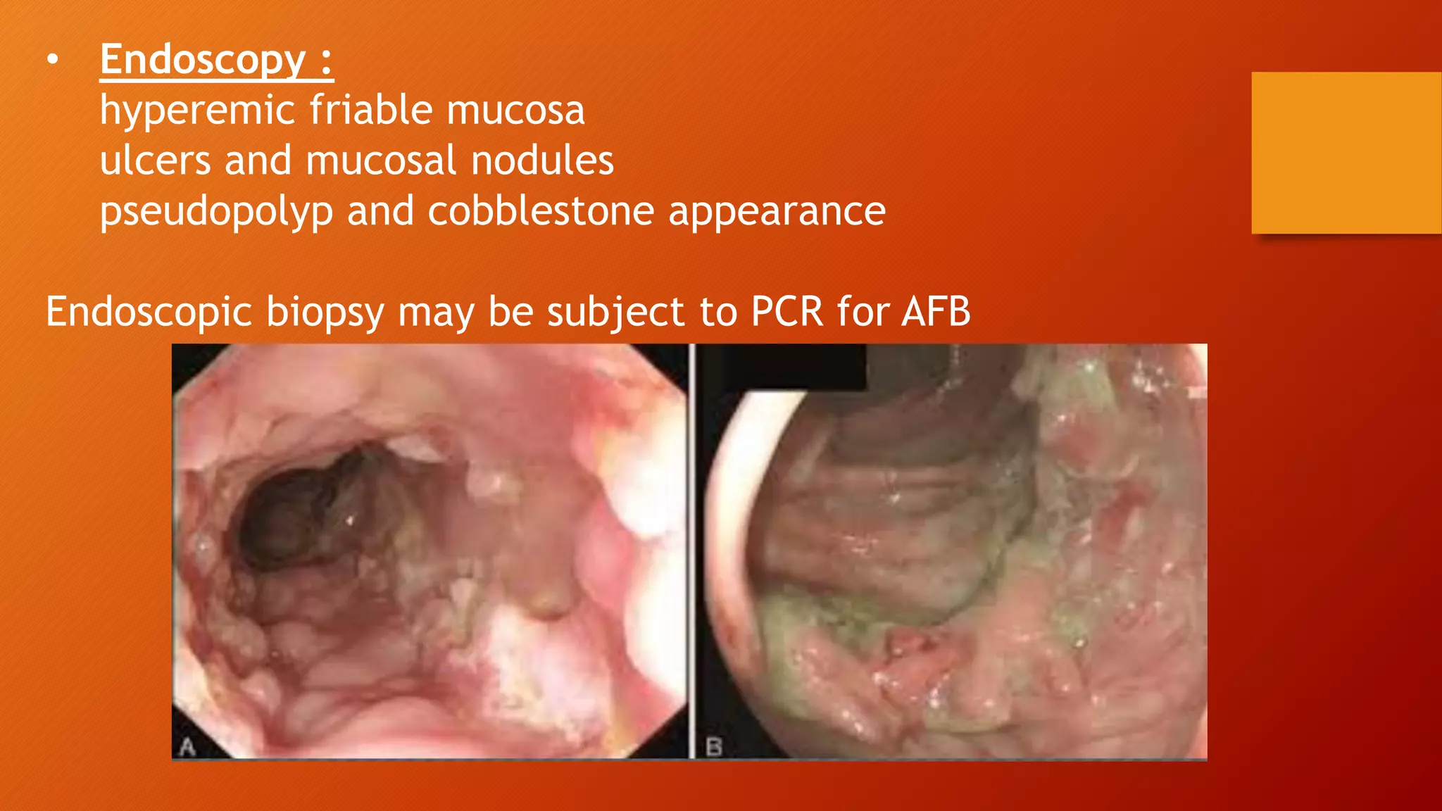 Abdominal tuberculosis | PPTX