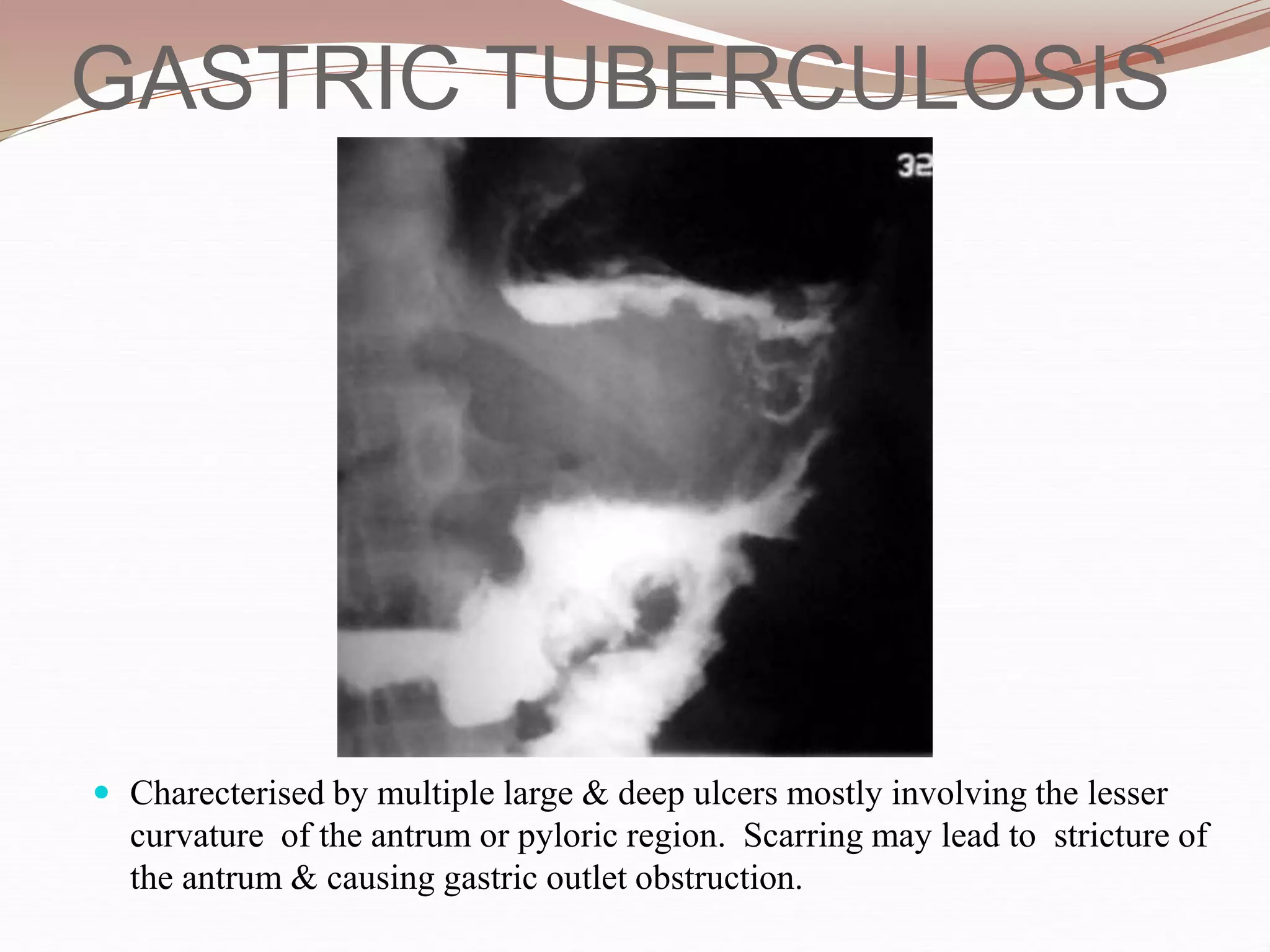 ABDOMINAL TUBERCULOSIS.ppt