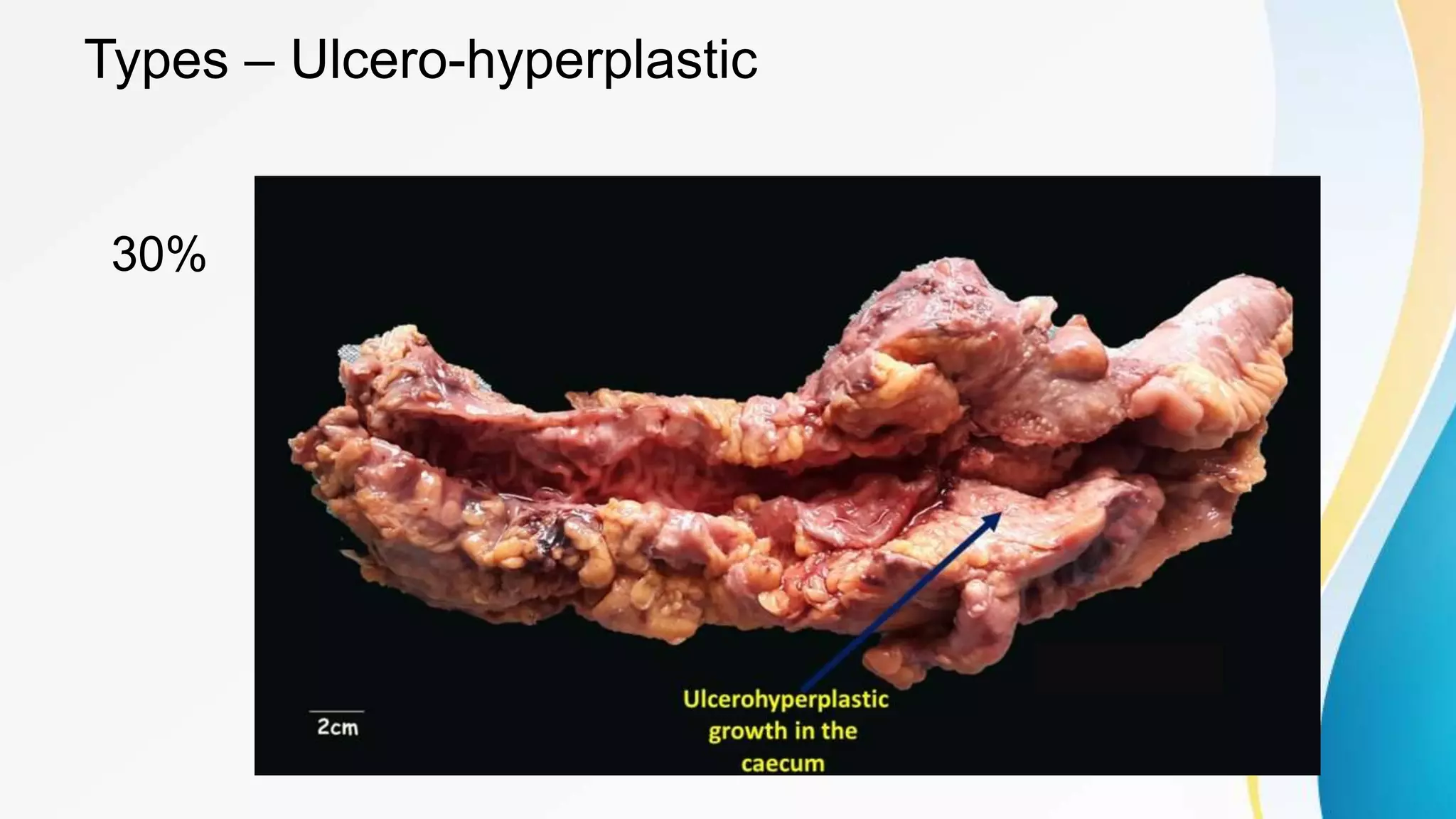 Abdominal Tuberculosis | PPTX