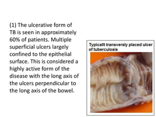 Abdominal tuberculosis gen. med | PPT