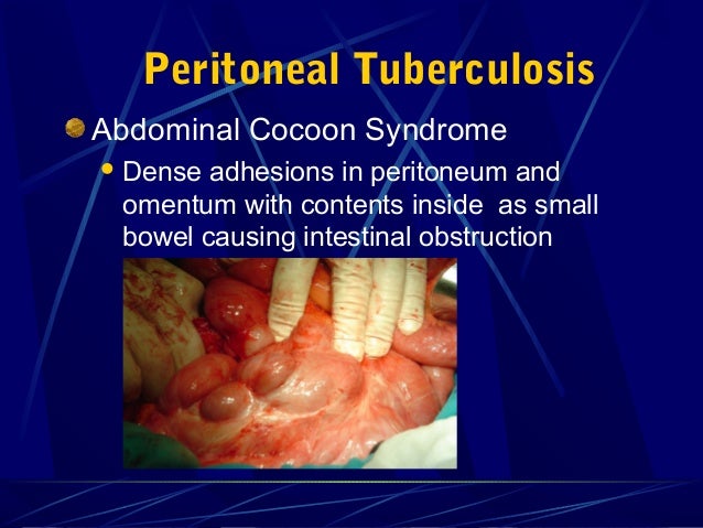 Abdominal tuberculosis by dr waseem ashraf skims