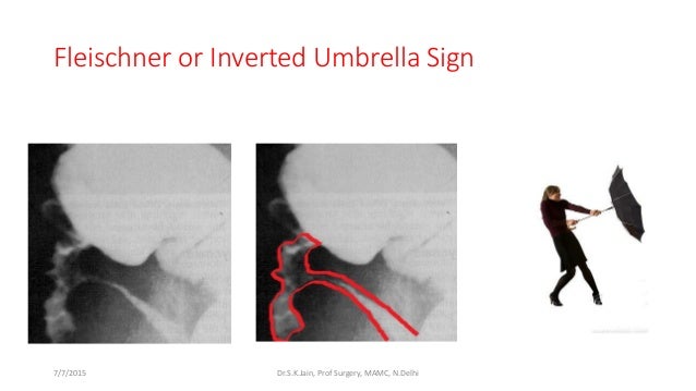 Abdominal tuberculosis