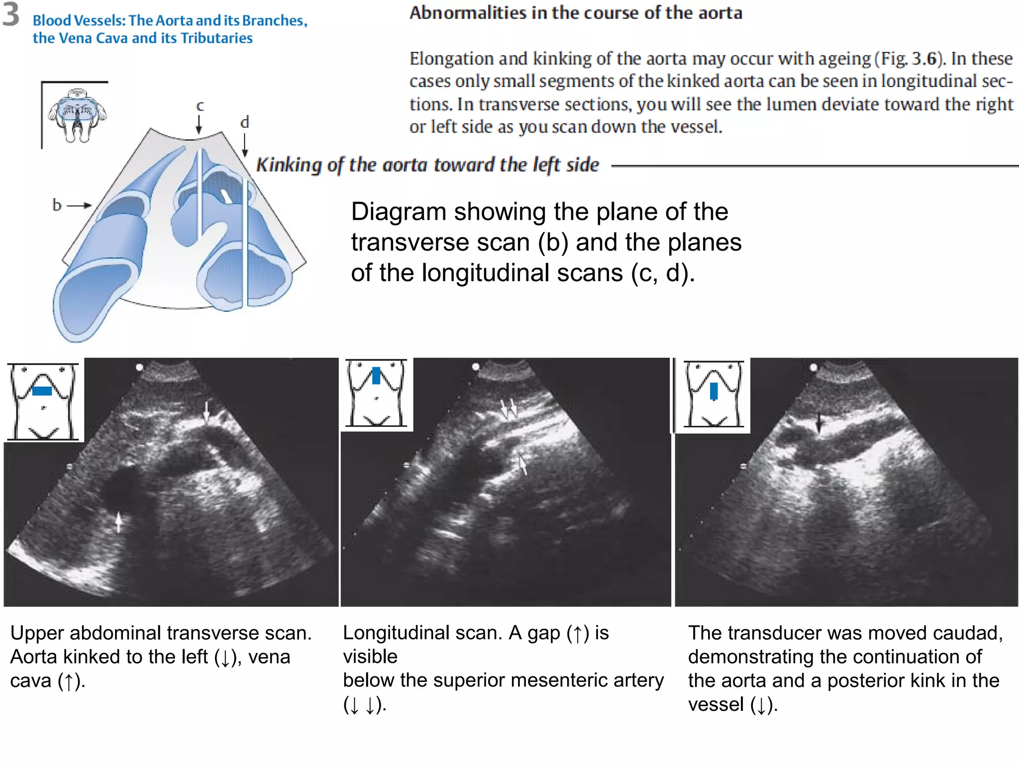 Blood vessels the aorta and its branches, | PPT