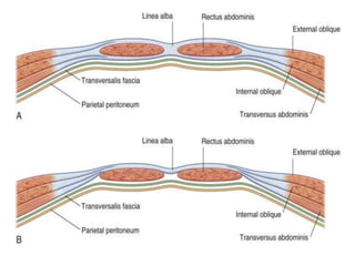 Abdominal wall anatomy | PPTX