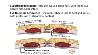 Abdominal Wall.pptx