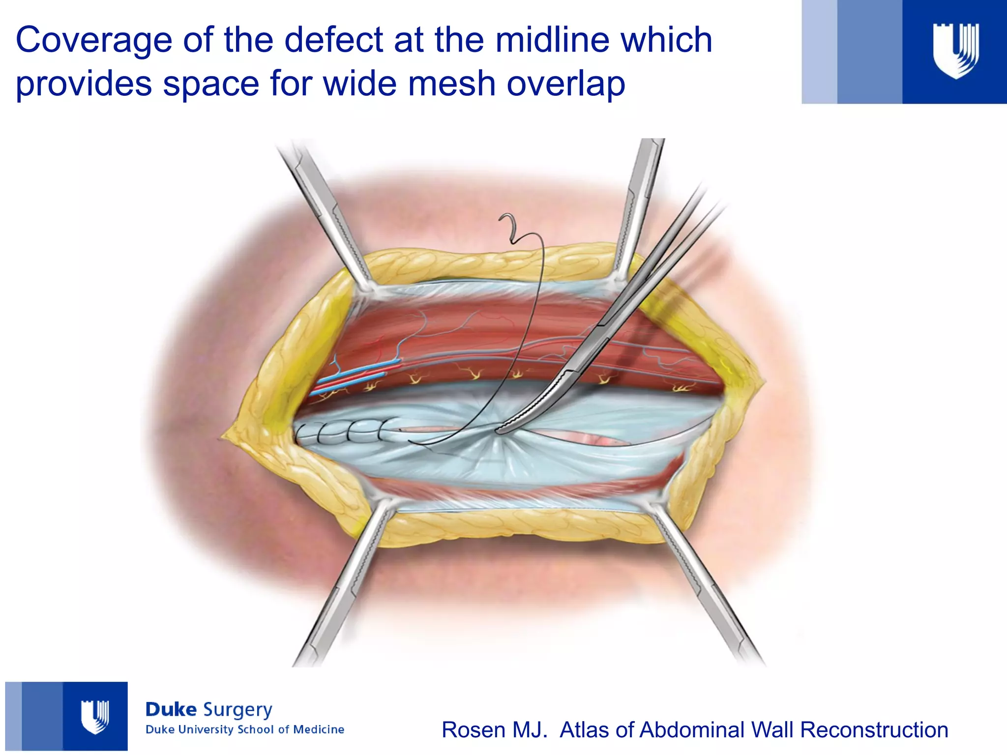 Abdominal Wall Anatomy With Respect To Understanding Component Separation Pdf