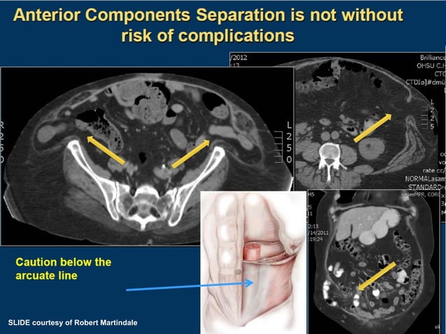 Abdominal wall anatomy with respect to understanding component ...