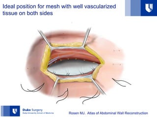 Abdominal wall anatomy with respect to understanding component ...