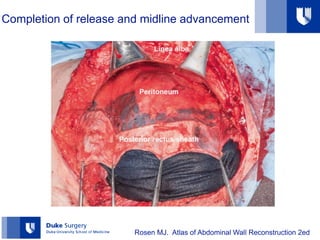 Abdominal wall anatomy with respect to understanding component ...