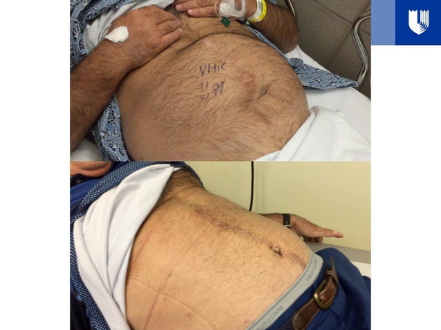 Abdominal wall anatomy with respect to understanding component ...