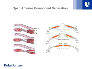 Abdominal wall anatomy with respect to understanding component separation.pdf