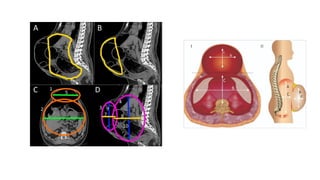 abdominal wall component separation.pptx