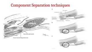 abdominal wall component separation.pptx